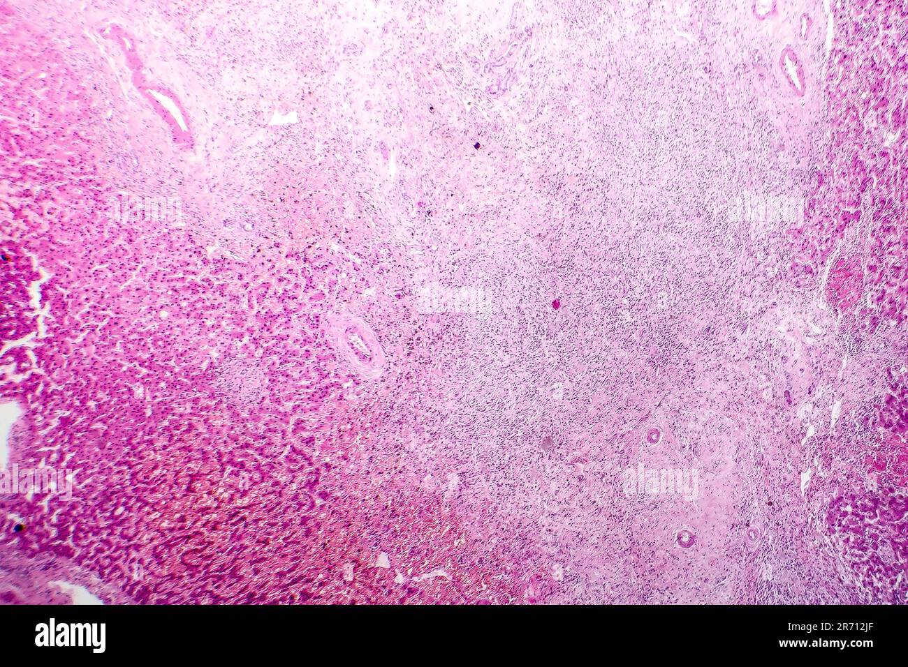Histopathology of liver abscess, light micrograph, hematoxylin and ...