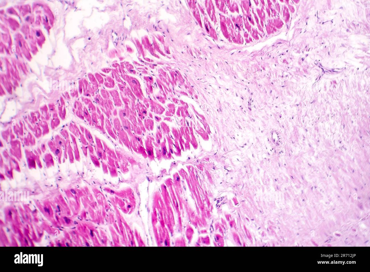 Acute Myocardial Infarction Histology Of Heart Tissue Light Micrograph Area Of Infarct Is