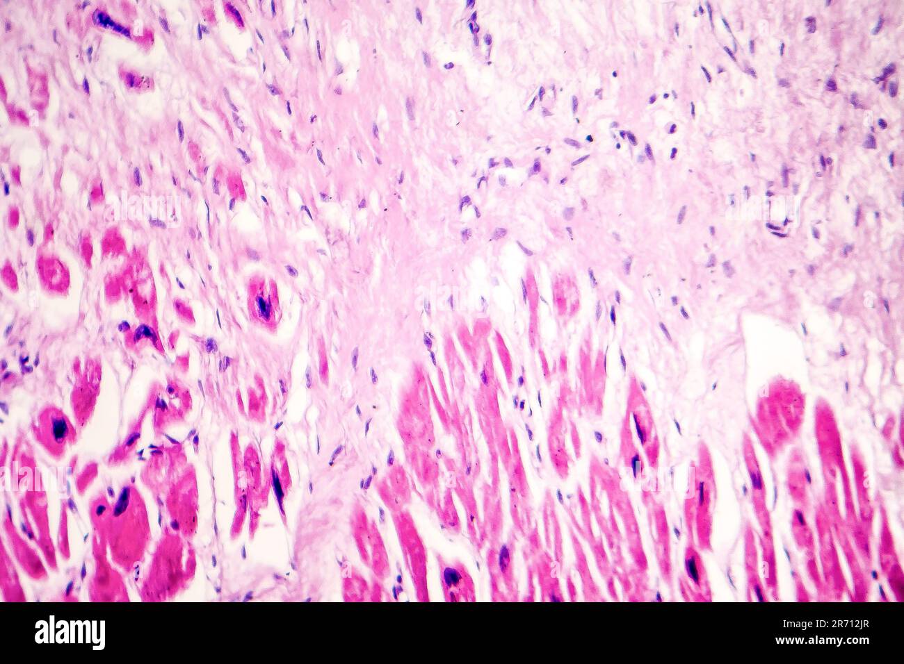 Acute myocardial infarction, histology of heart tissue, light ...