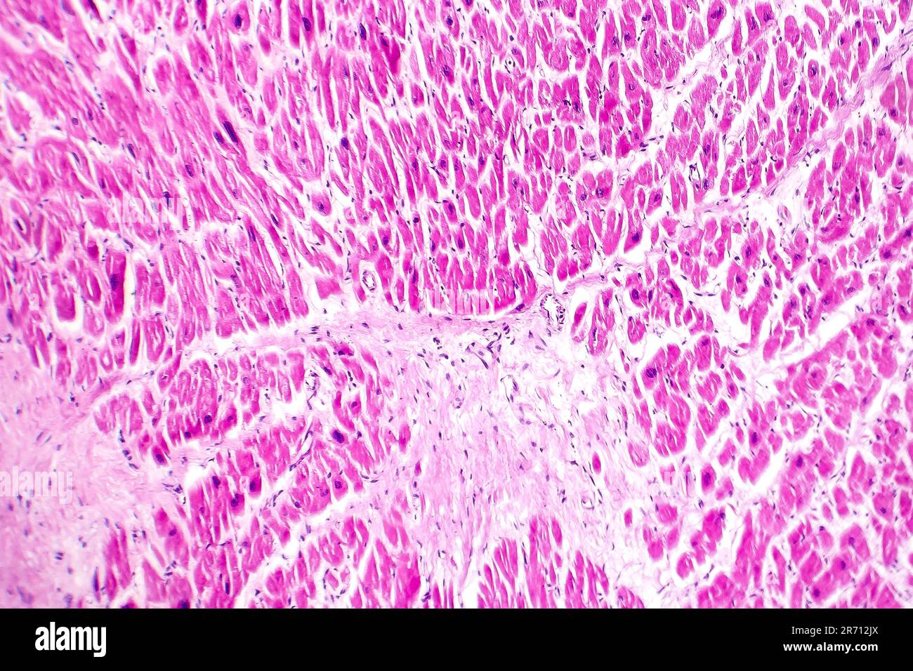 Acute myocardial infarction, histology of heart tissue, light ...
