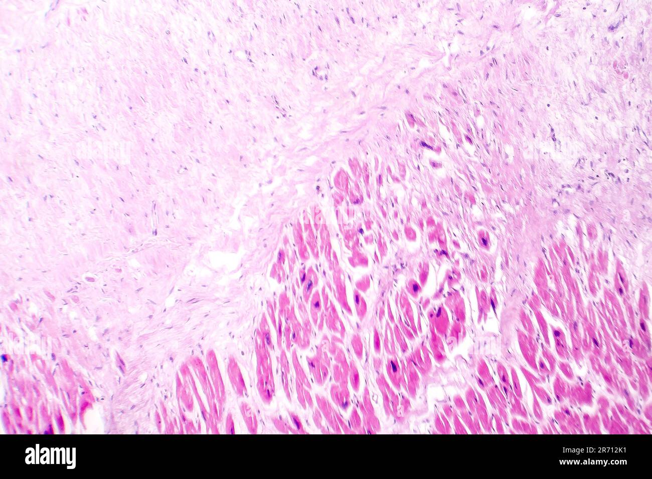 Acute Myocardial Infarction Histology Of Heart Tissue