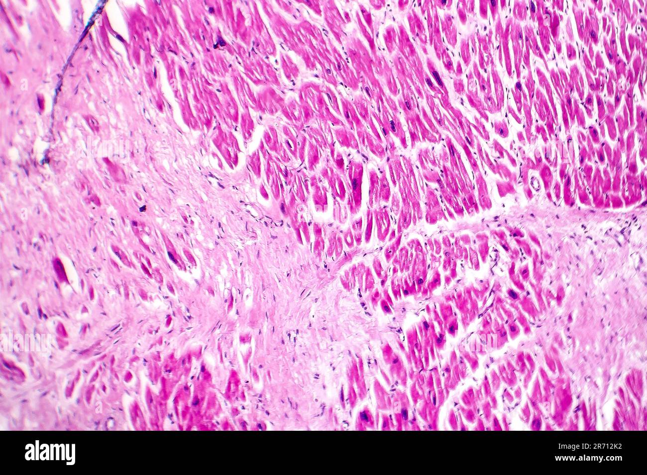 Acute myocardial infarction, histology of heart tissue, light ...