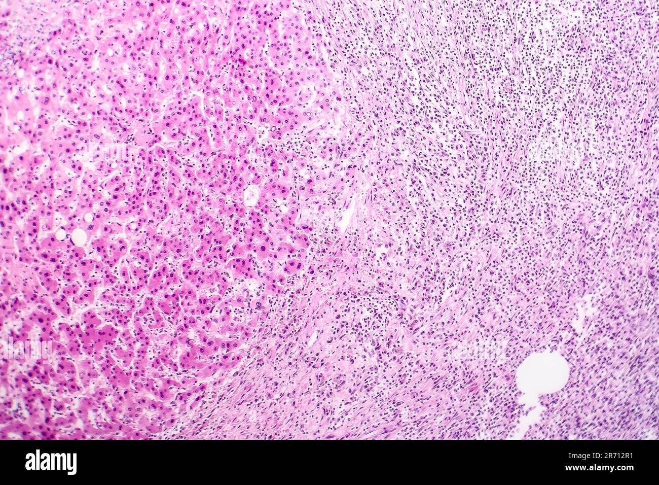 Histopathology of liver abscess, light micrograph, hematoxylin and ...