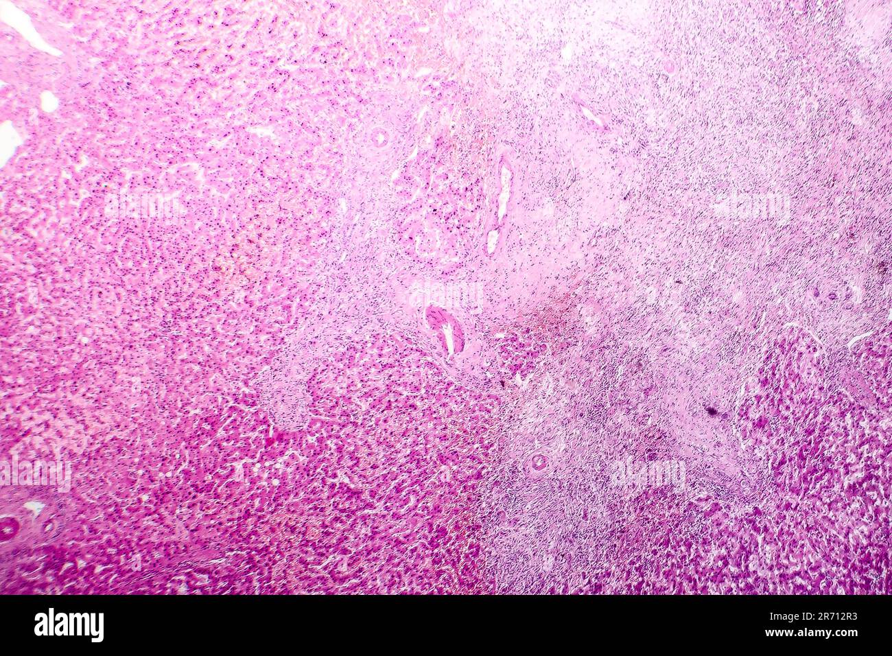 Histopathology of liver abscess, light micrograph, hematoxylin and eosin staining Stock Photo ...
