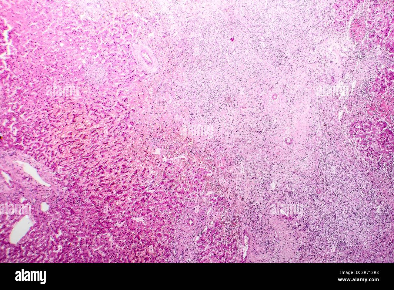 Histopathology of liver abscess, light micrograph, hematoxylin and ...