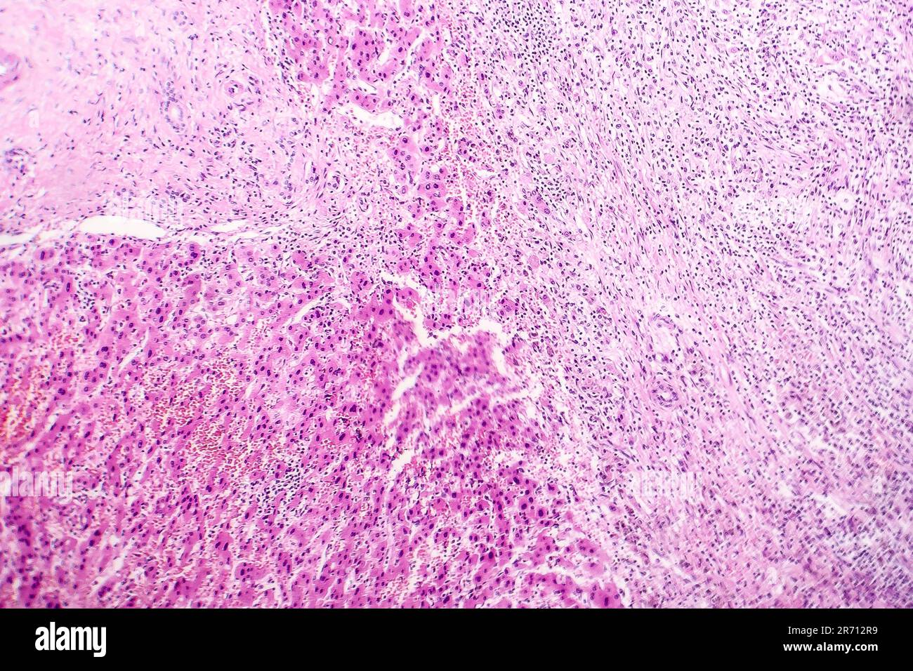Histopathology of liver abscess, light micrograph, hematoxylin and ...