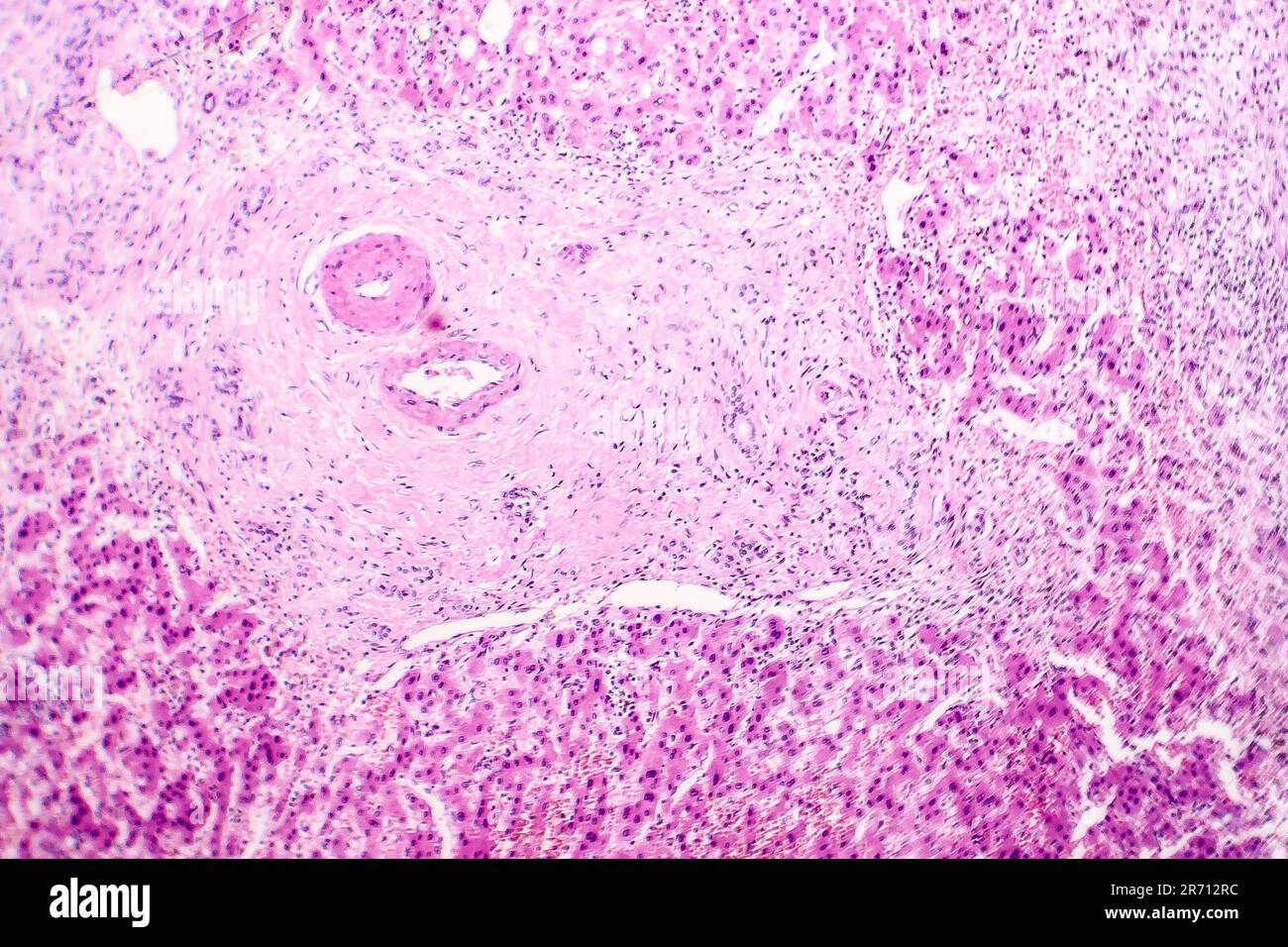 Histopathology of liver abscess, light micrograph, hematoxylin and eosin staining Stock Photo ...