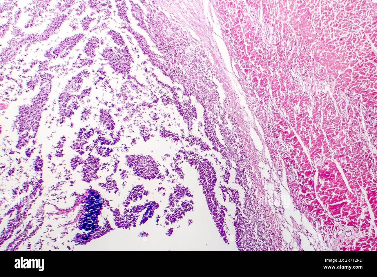 Histopathology of bacterial myocarditis, inflammatory heart disease ...