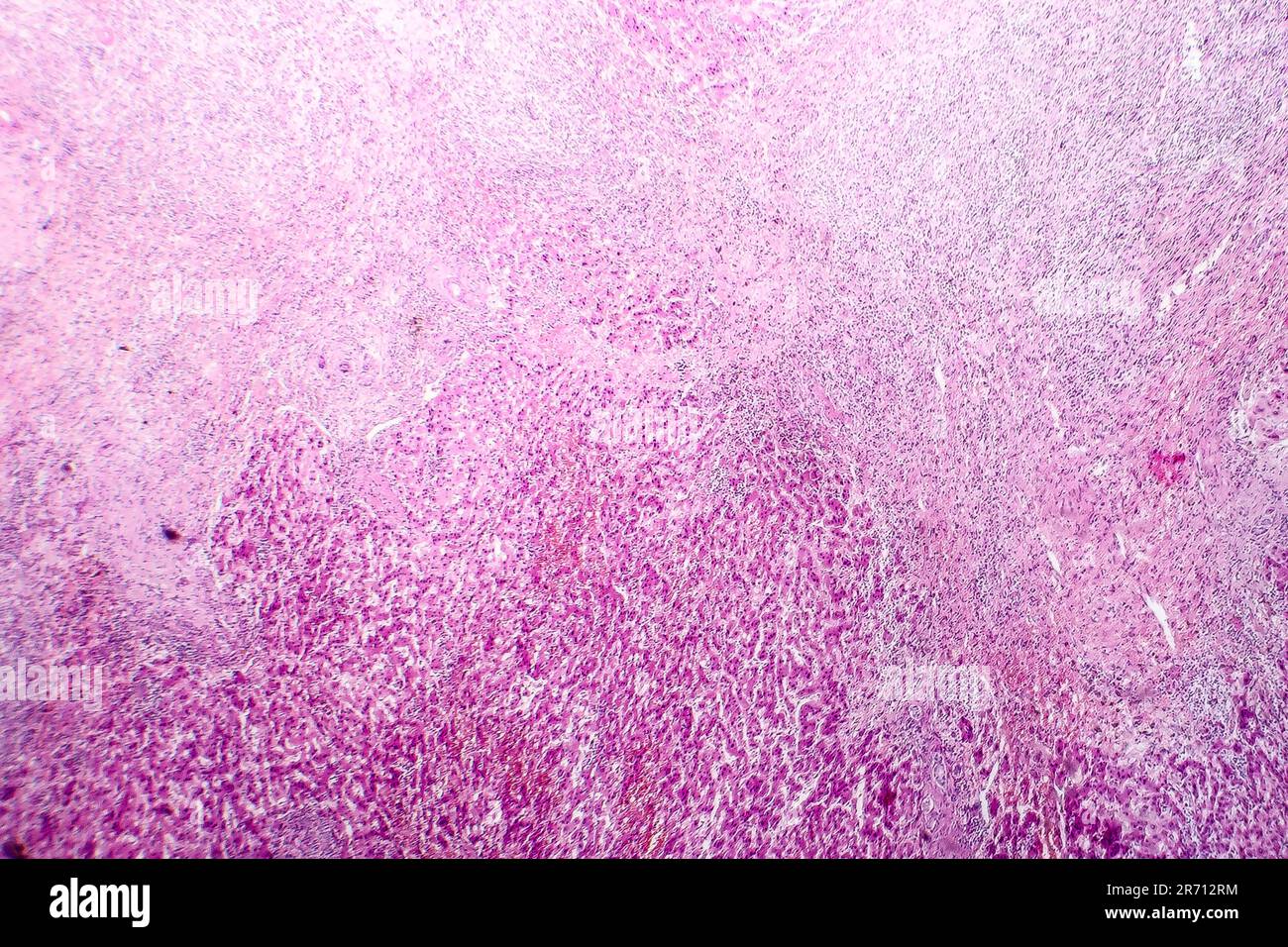 Histopathology of liver abscess, light micrograph, hematoxylin and eosin staining Stock Photo ...