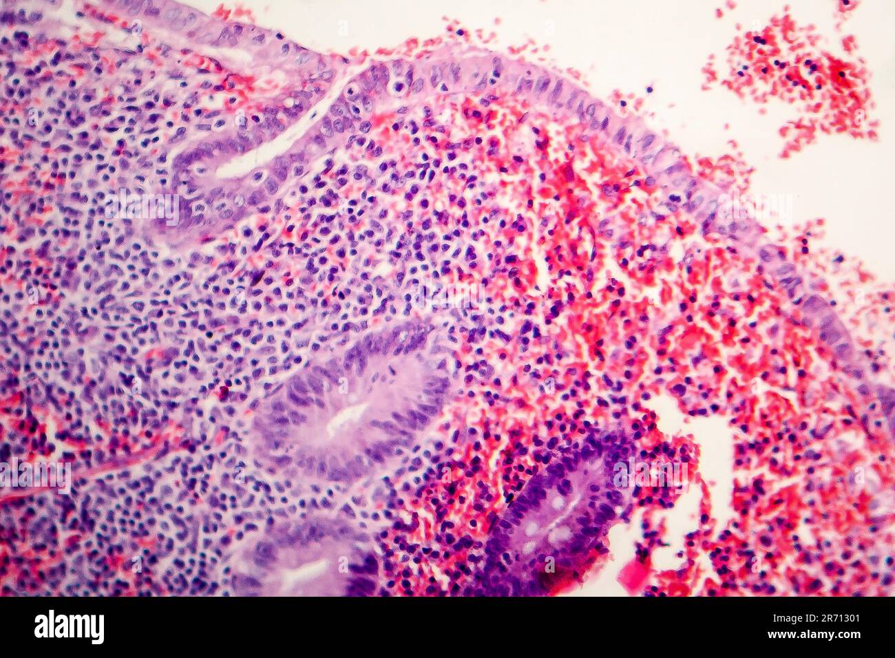 Histopathology of chronic appendicitis, light micrograph, photo under ...