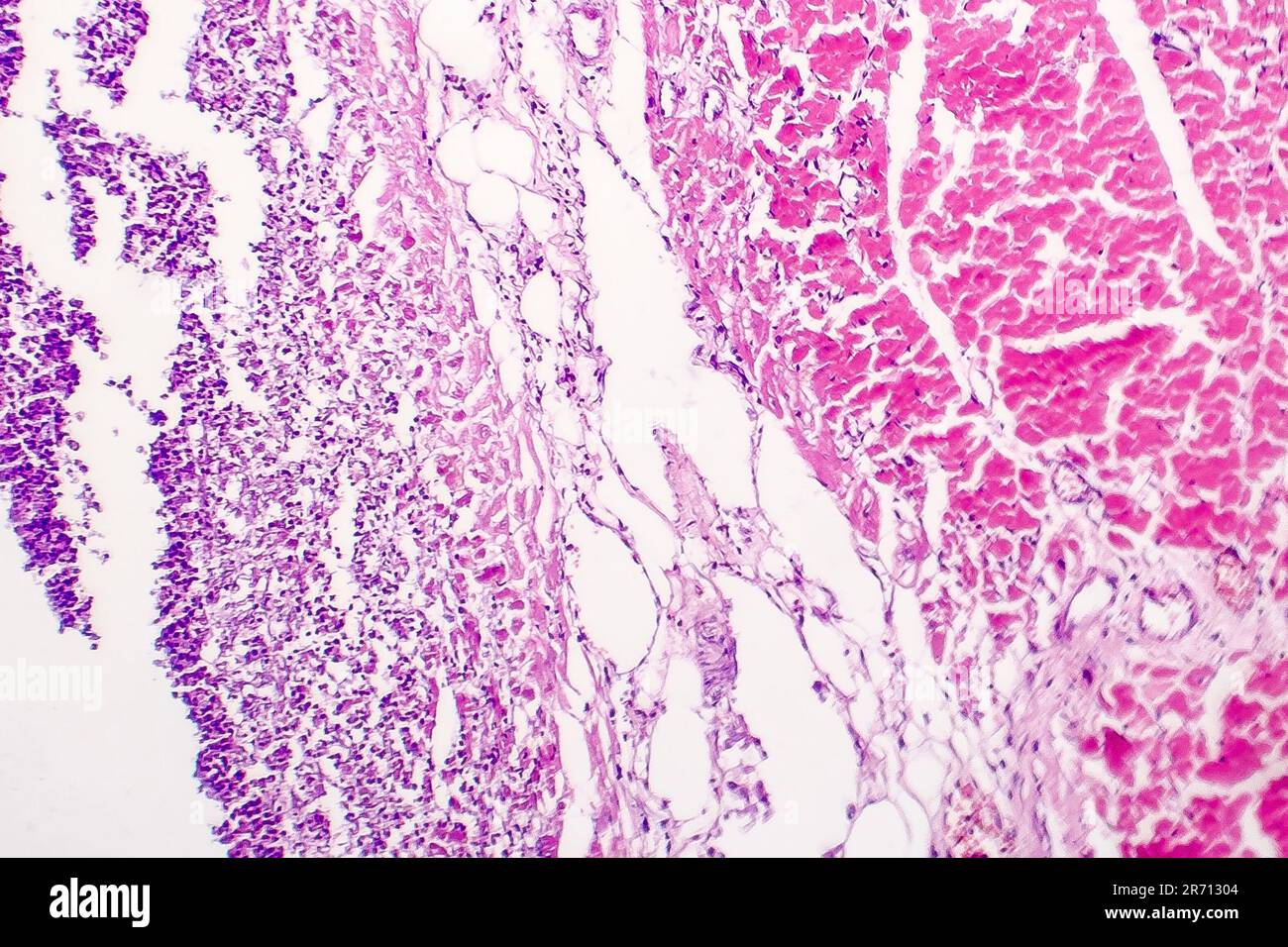 Histopathology of bacterial myocarditis, inflammatory heart disease ...