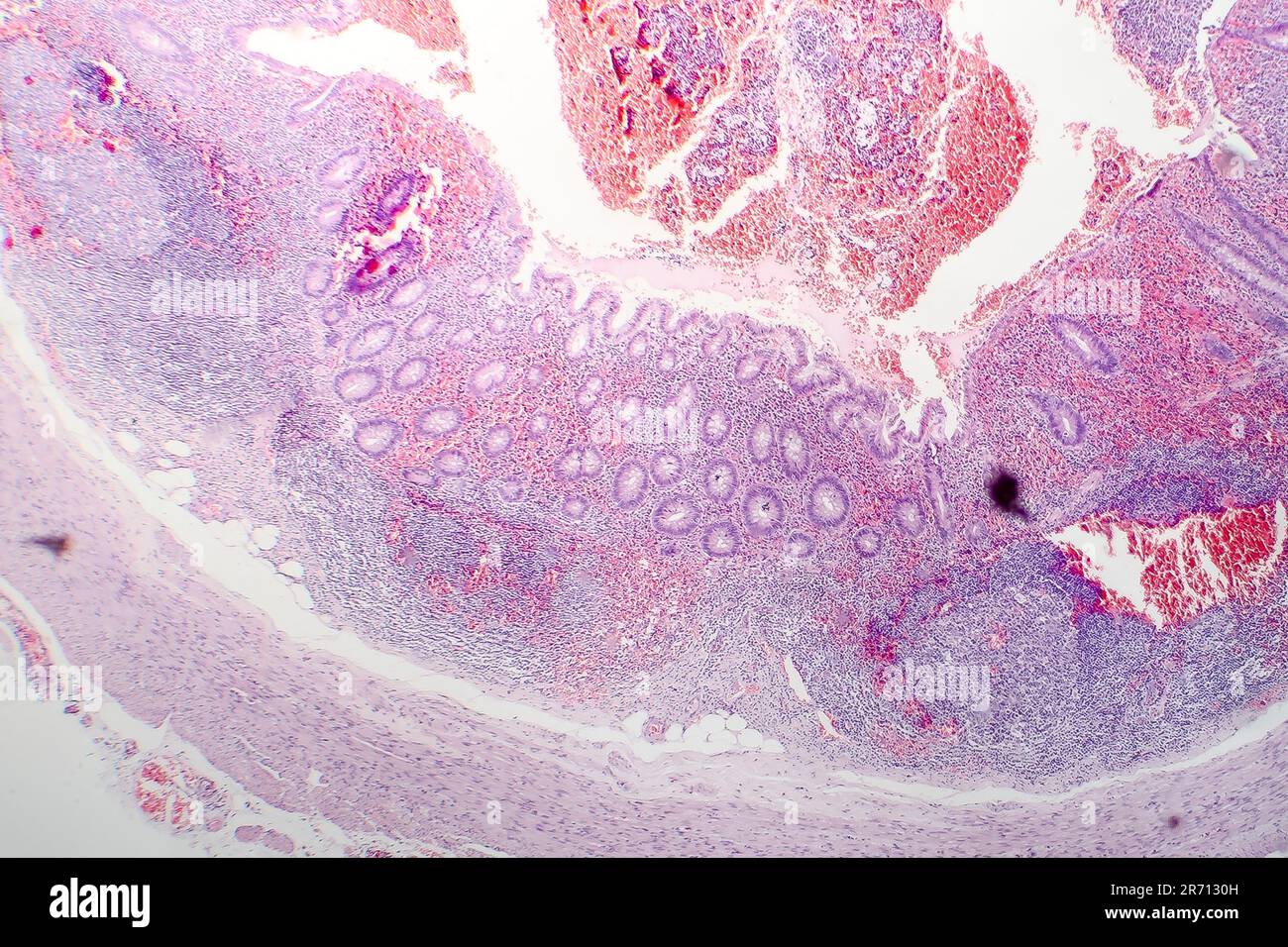 Histopathology of chronic appendicitis, light micrograph, photo under ...