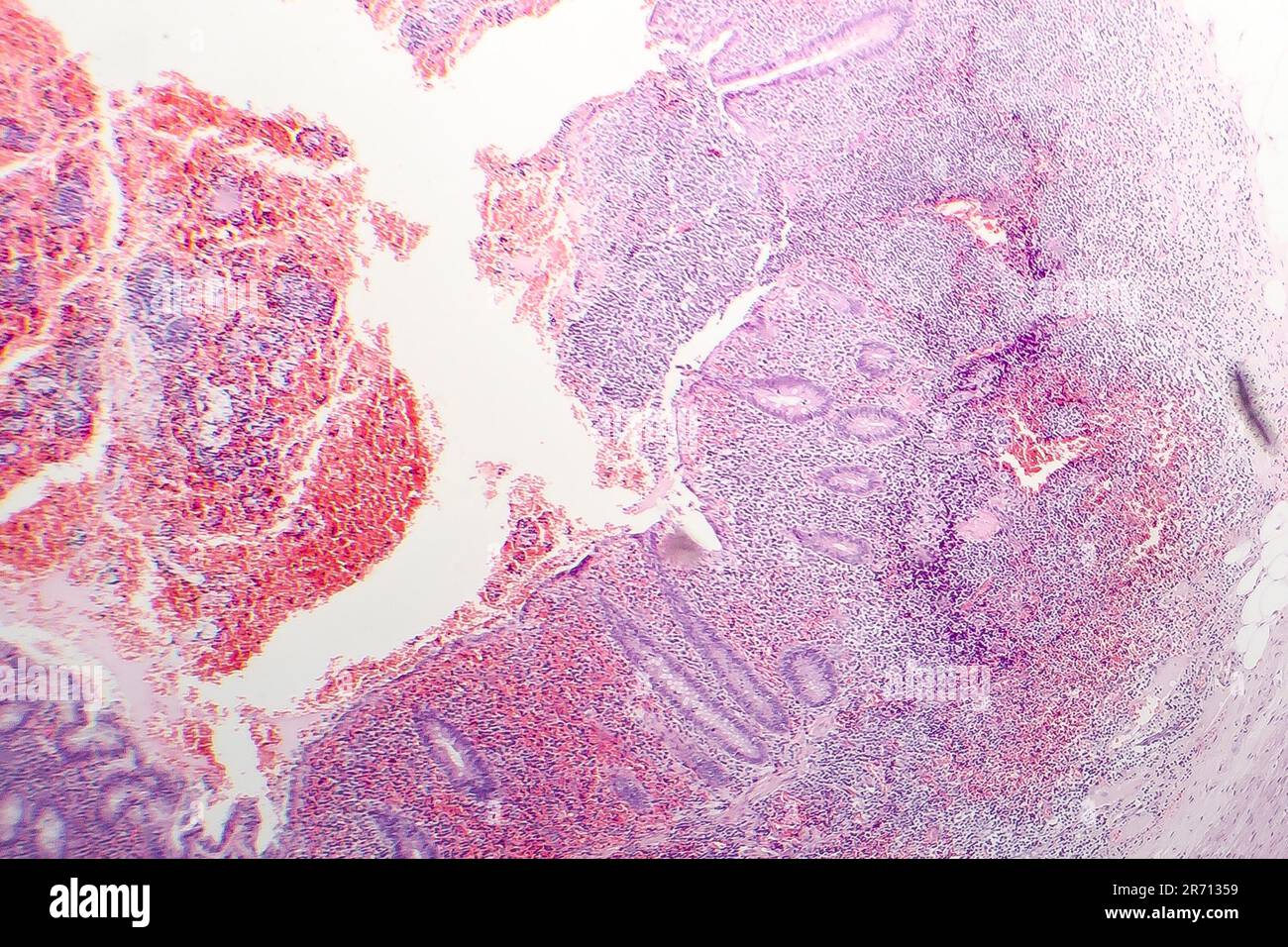 Histopathology of chronic appendicitis, light micrograph, photo under ...