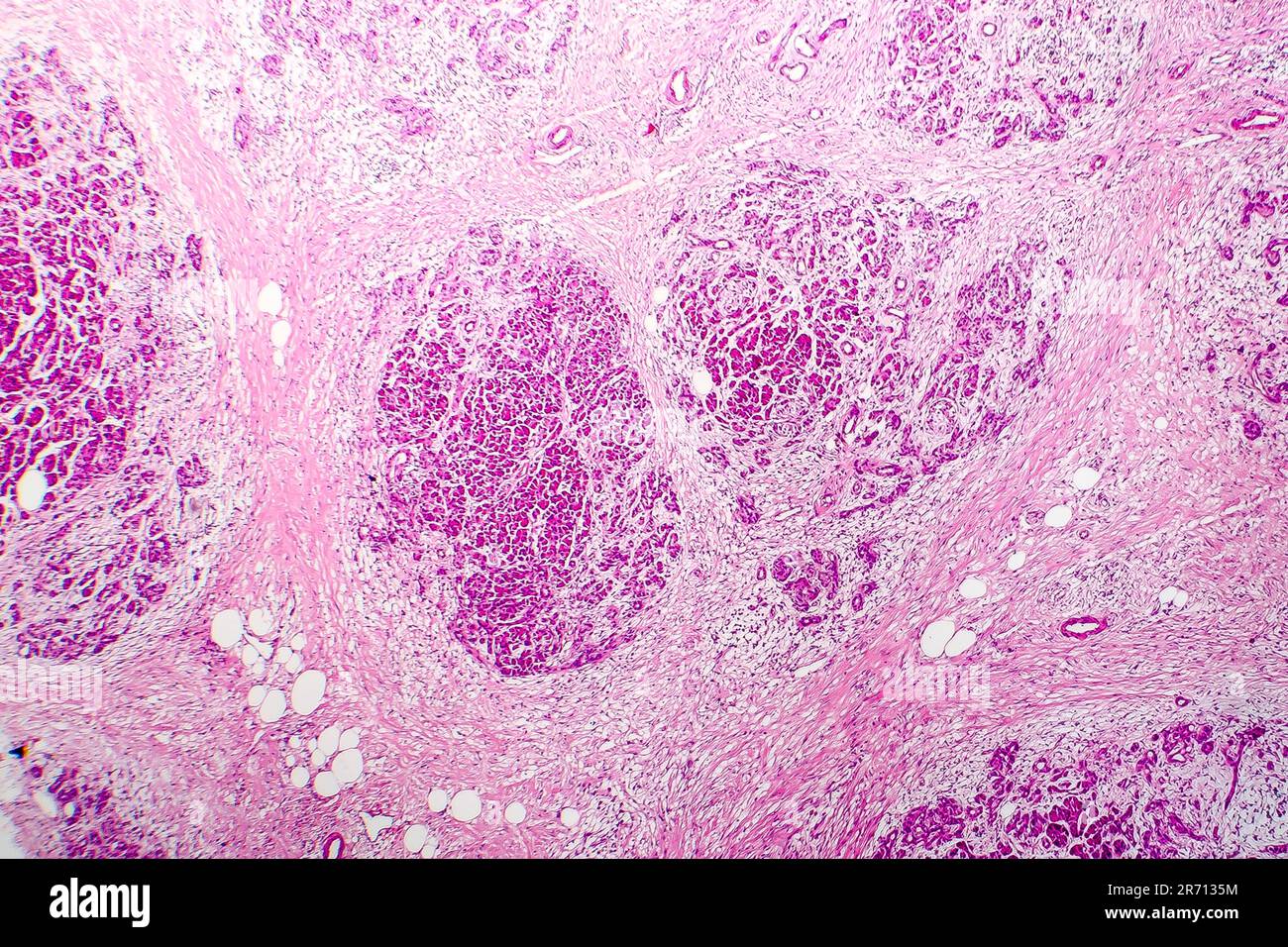 Acute hemorrhagic pancreatitis, light micrograph, hematoxylin and eosin ...