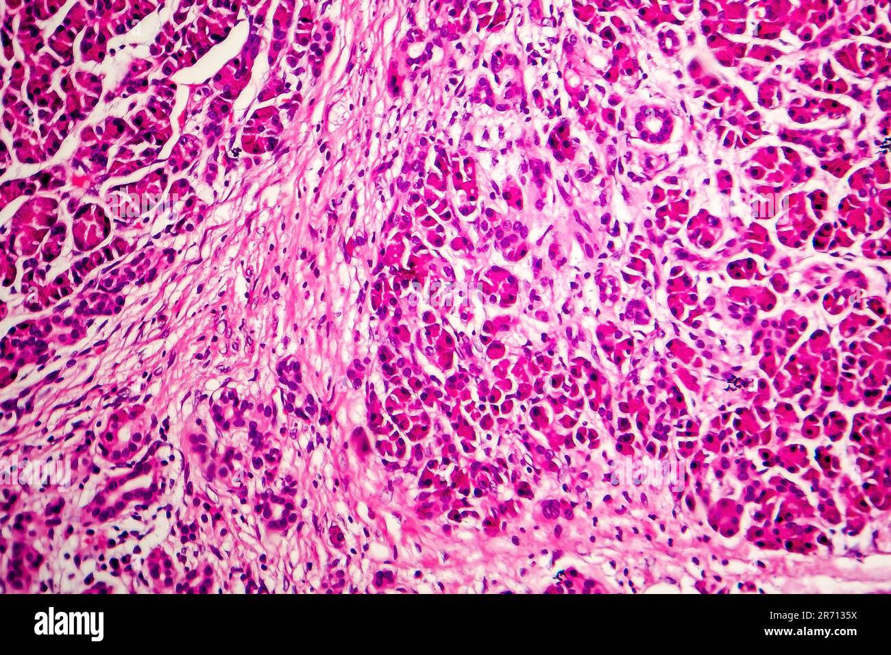 Acute hemorrhagic pancreatitis, light micrograph, hematoxylin and eosin ...