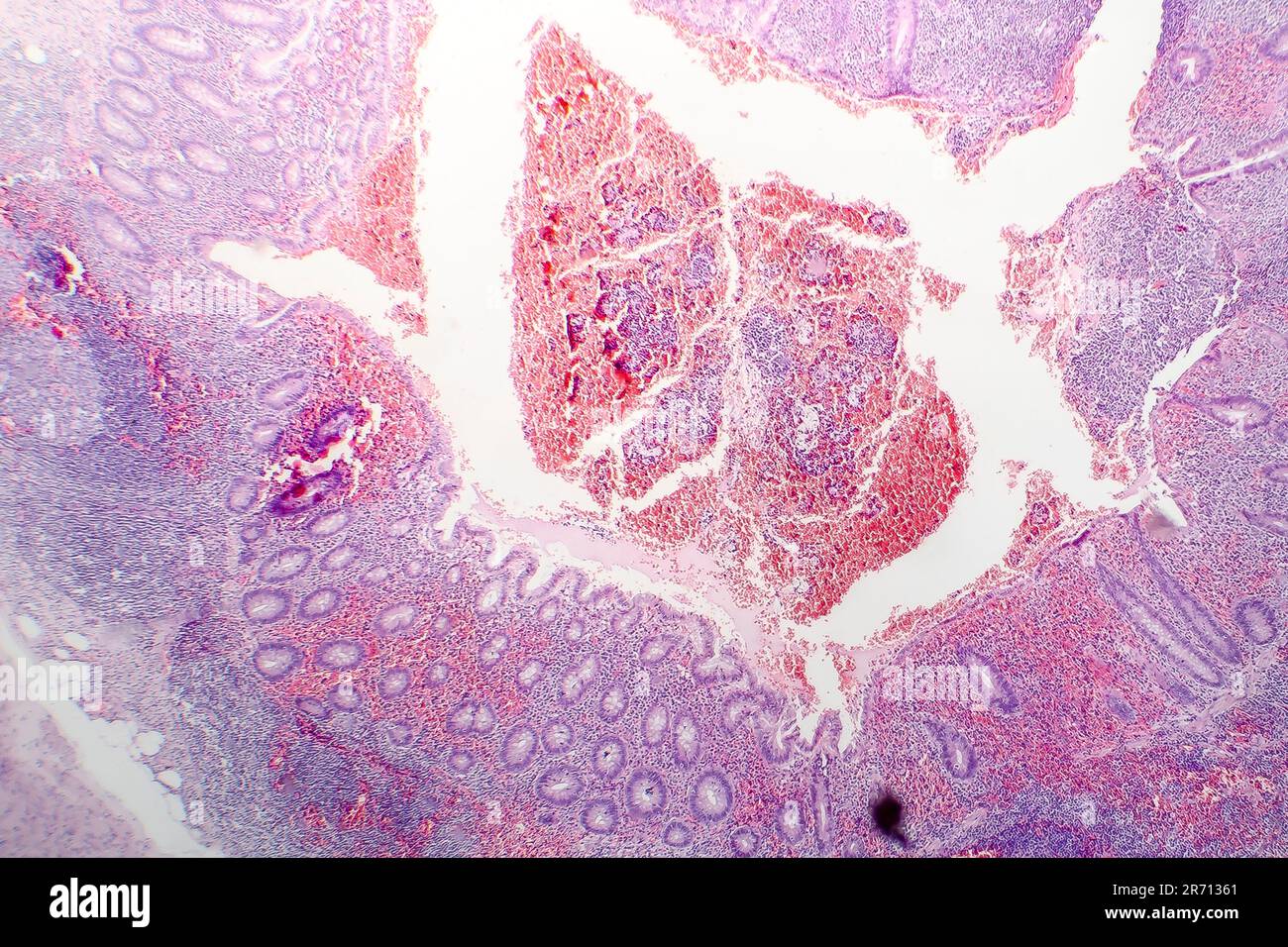 Histopathology of chronic appendicitis, light micrograph, photo under ...