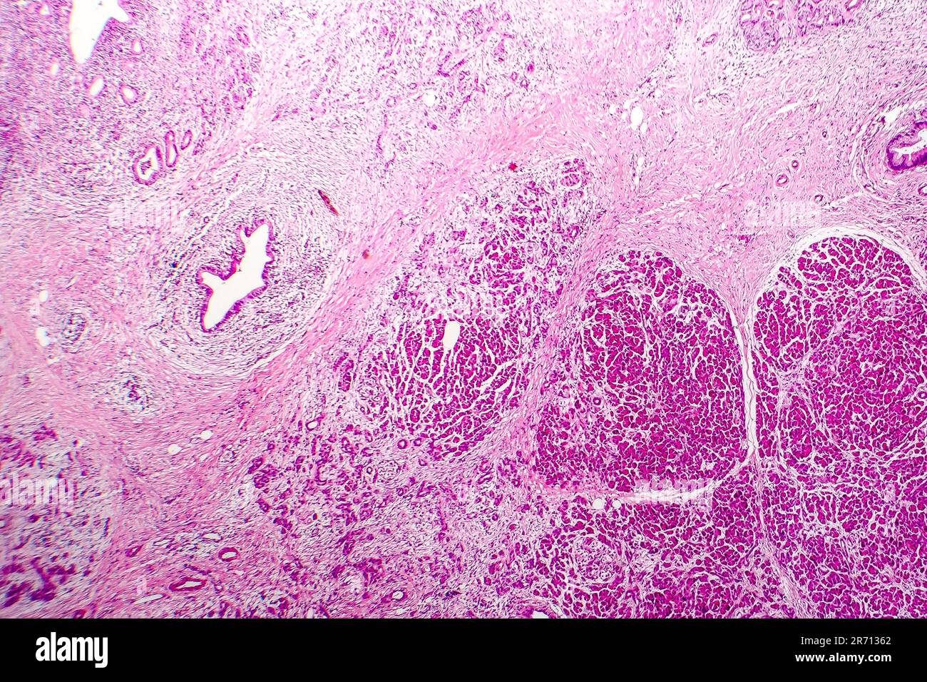 Acute hemorrhagic pancreatitis, light micrograph, hematoxylin and eosin ...