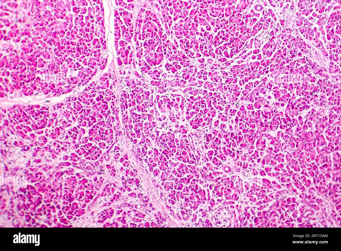 Acute hemorrhagic pancreatitis, light micrograph, hematoxylin and eosin ...