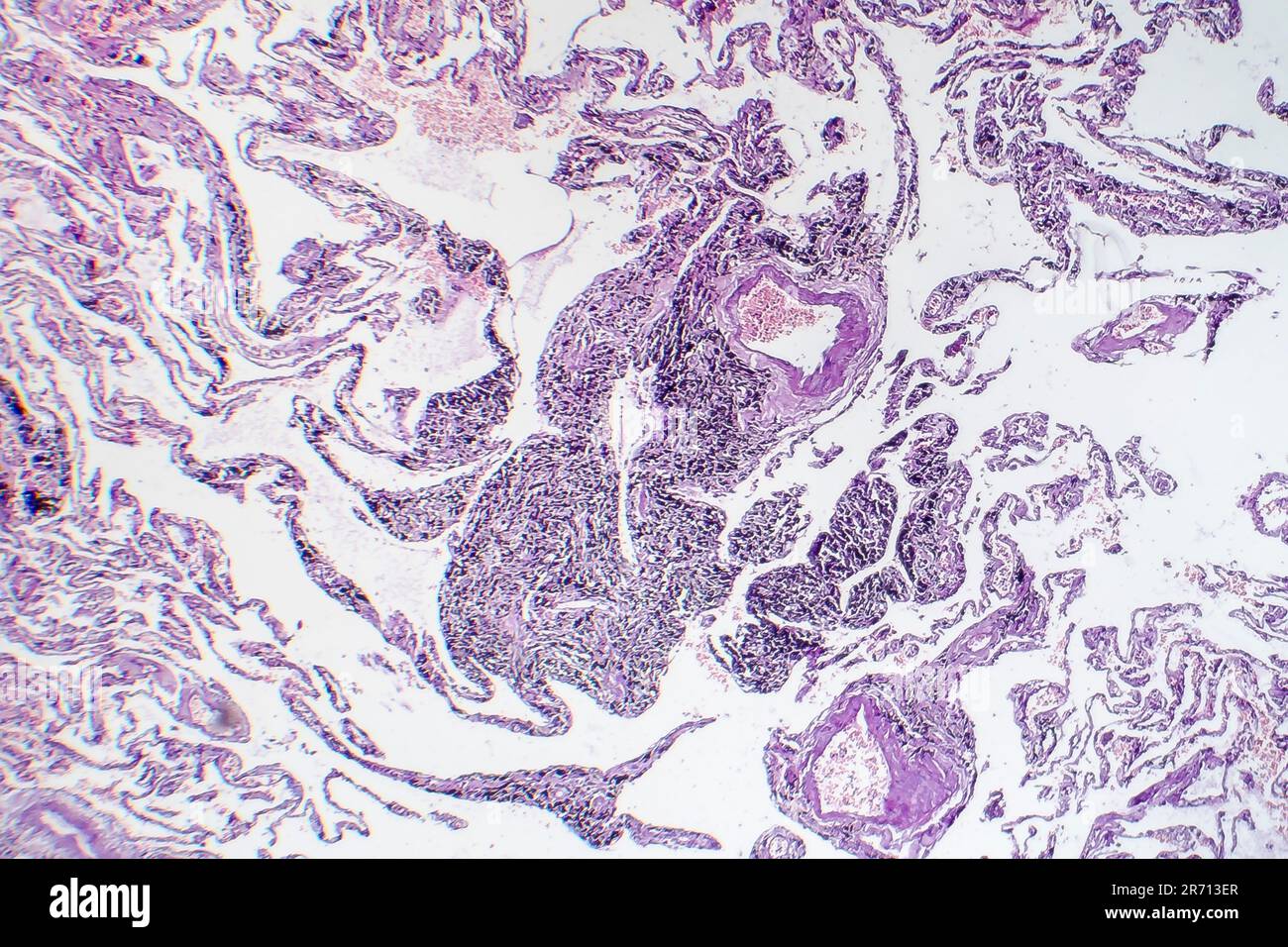 Smoker's lung, histopathology, light micrograph showing accumulation of ...