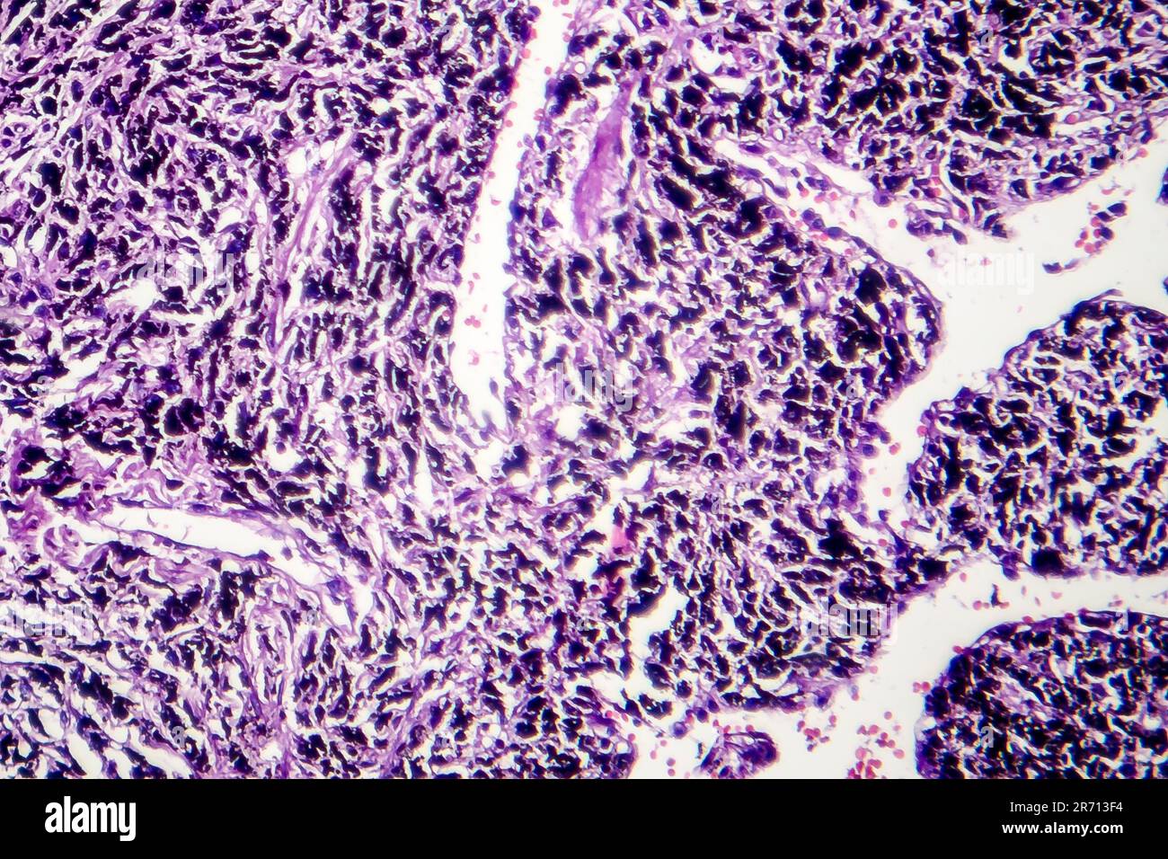 Smoker's lung, histopathology, light micrograph showing accumulation of ...