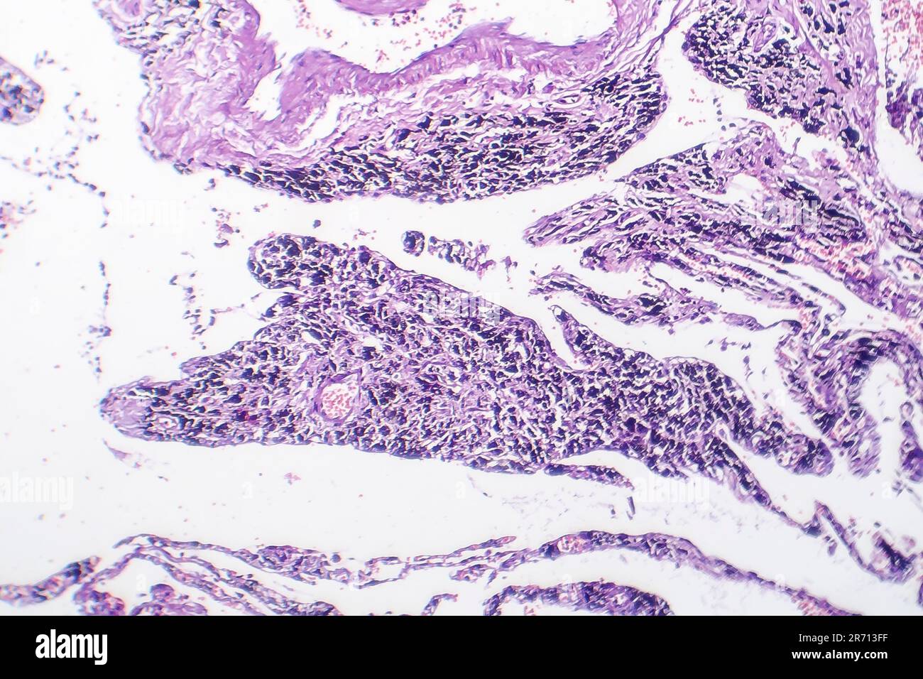 Smoker's lung, histopathology, light micrograph showing accumulation of ...