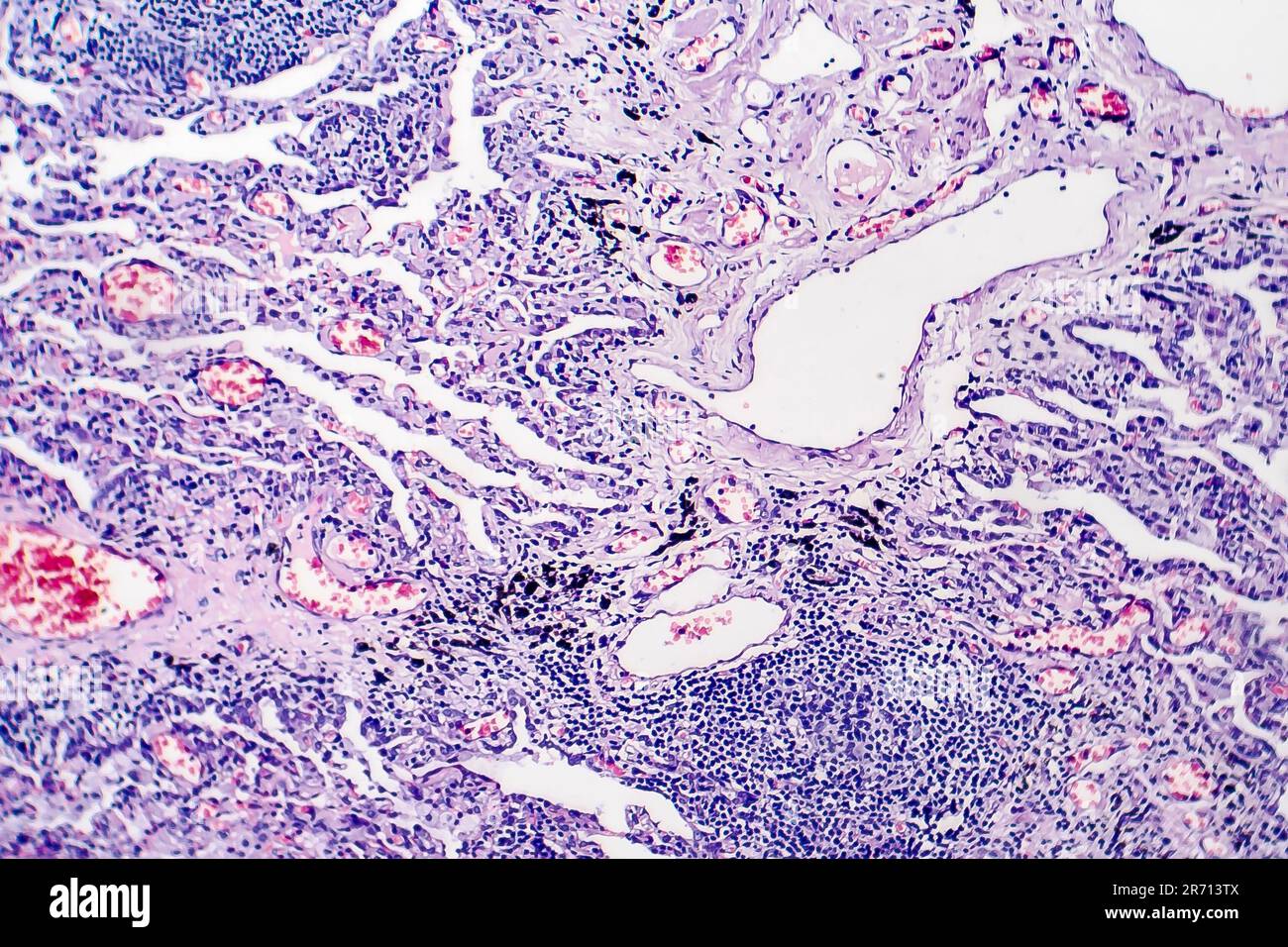 Tuberculosis Lungs Histology