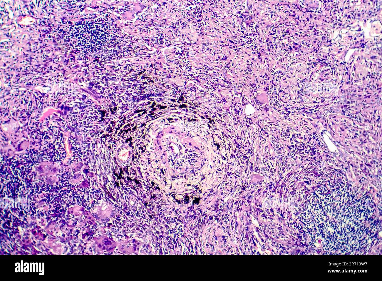 Tuberculosis Histology
