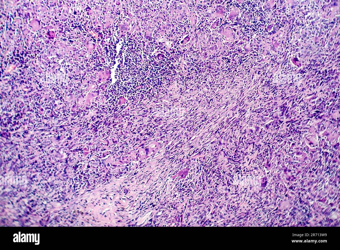 Histopathology of tuberculosis, light micrograph of tuberculosis lesion ...