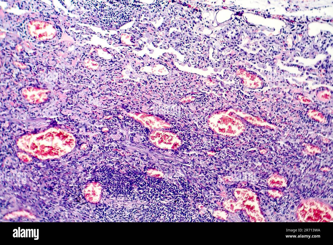 Histopathology of tuberculosis, light micrograph of tuberculosis lesion ...