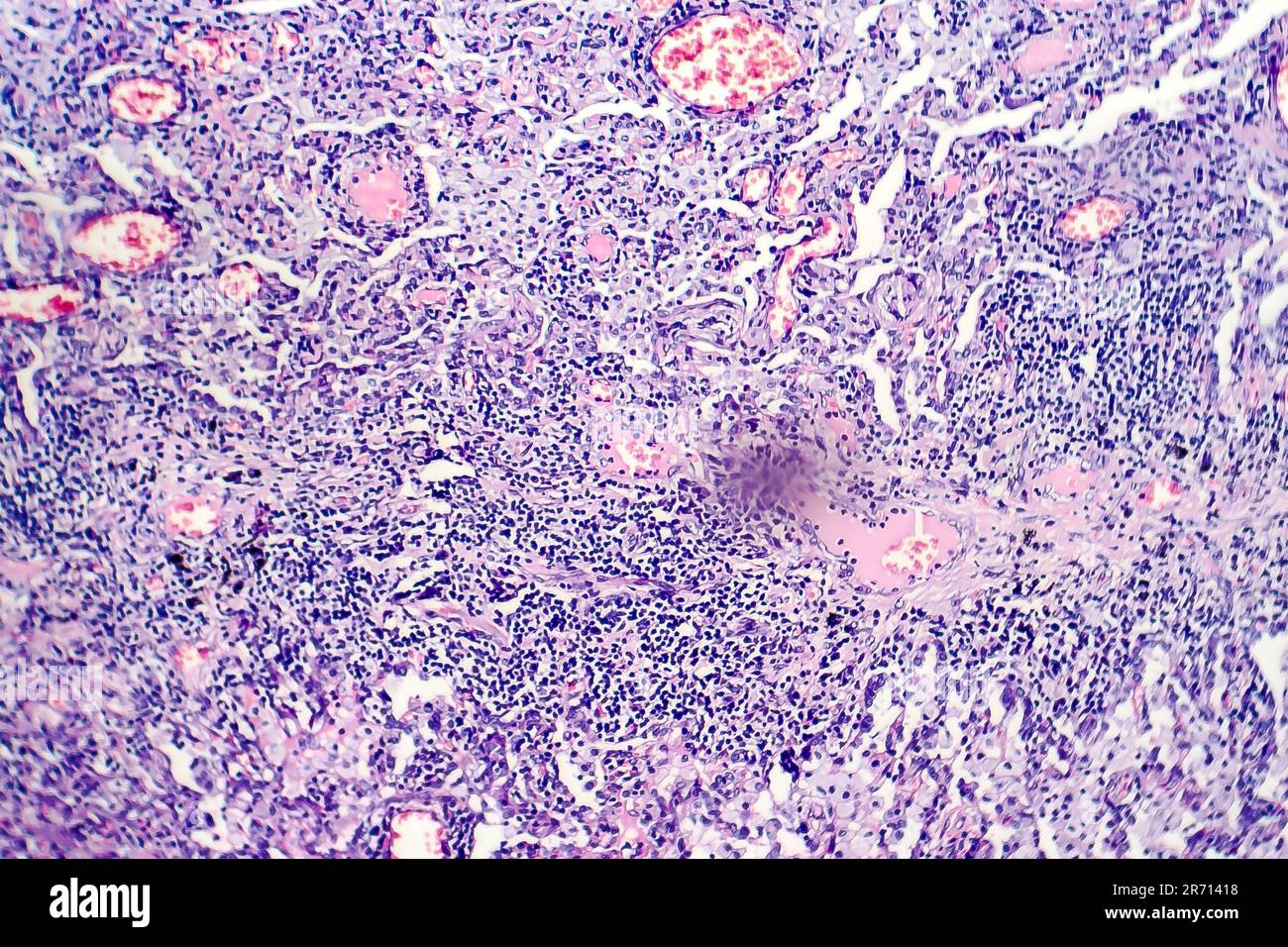 Histopathology of tuberculosis, light micrograph of tuberculosis lesion ...