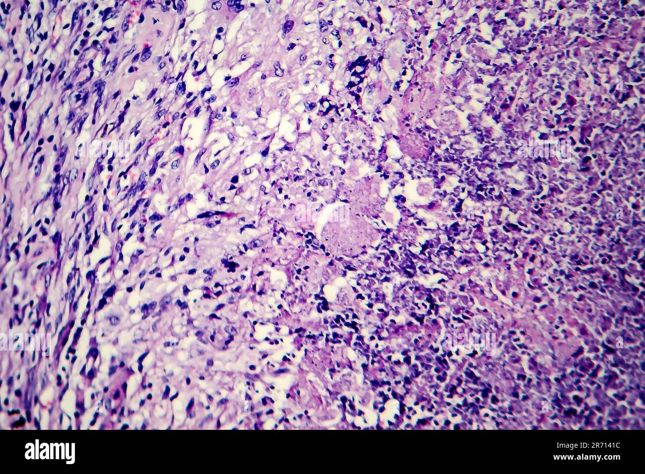 Histopathology of tuberculosis, light micrograph of tuberculosis lesion ...