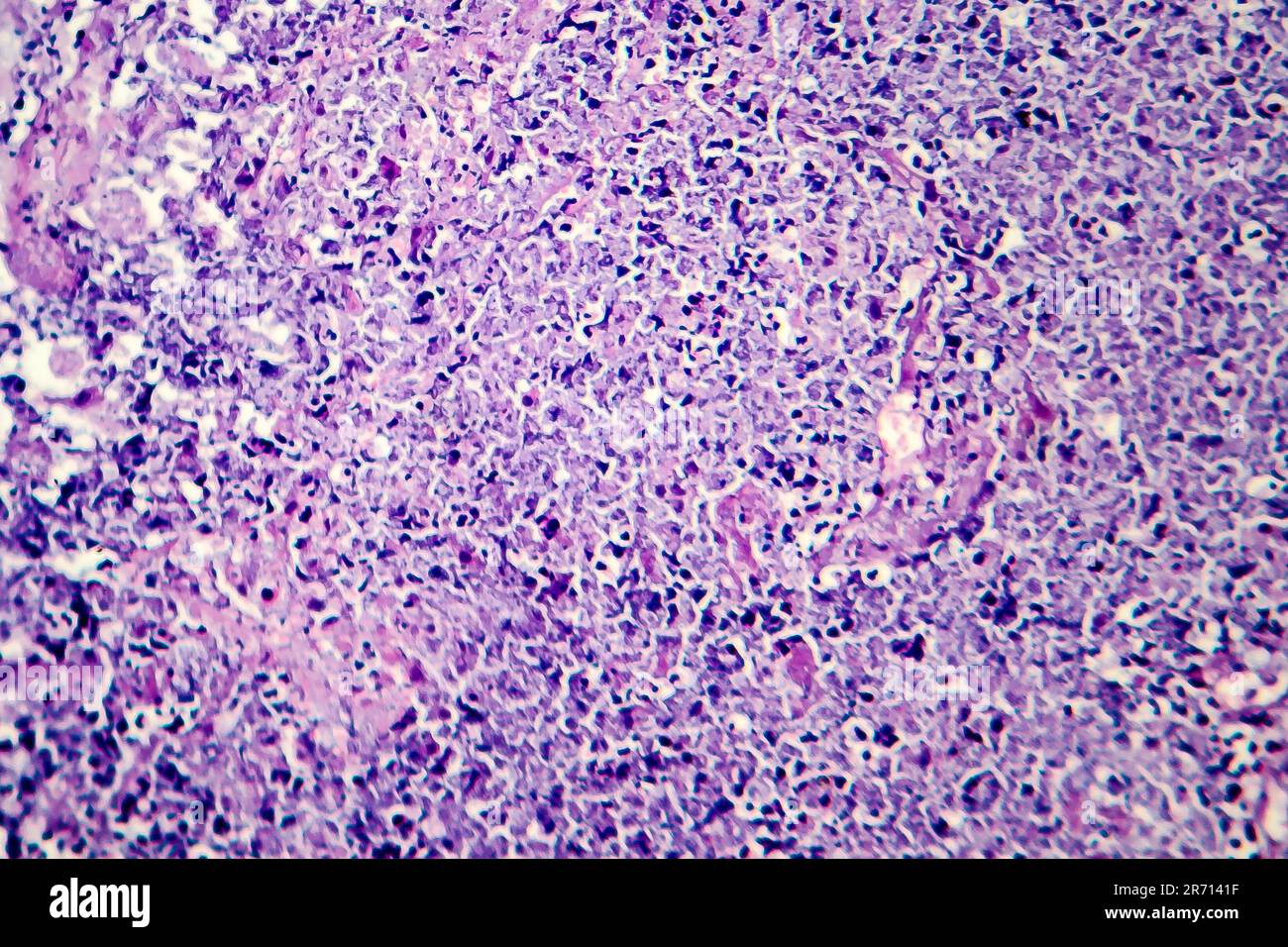 Histopathology of tuberculosis, light micrograph of tuberculosis lesion ...