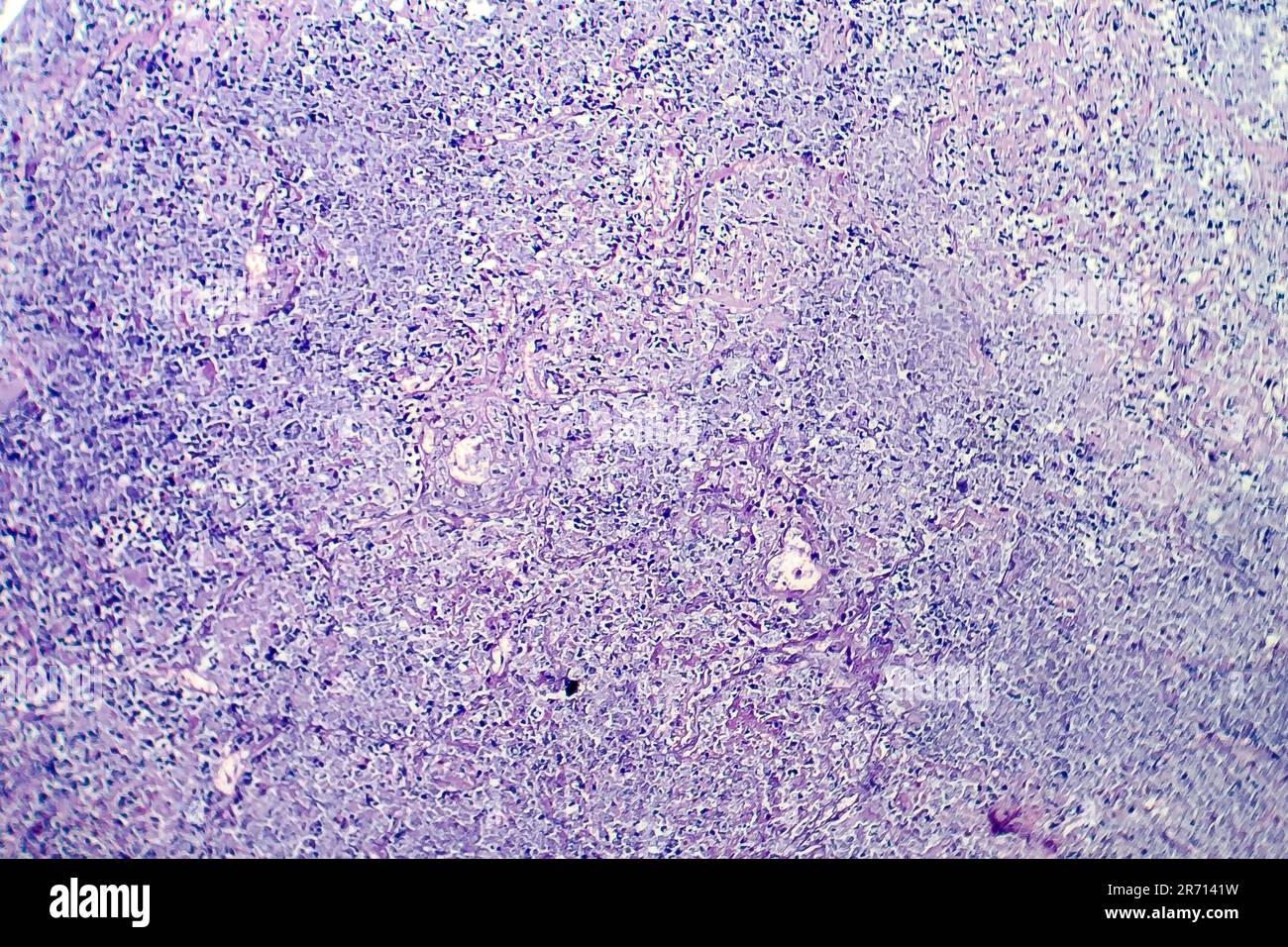 Histopathology of tuberculosis, light micrograph of tuberculosis lesion ...