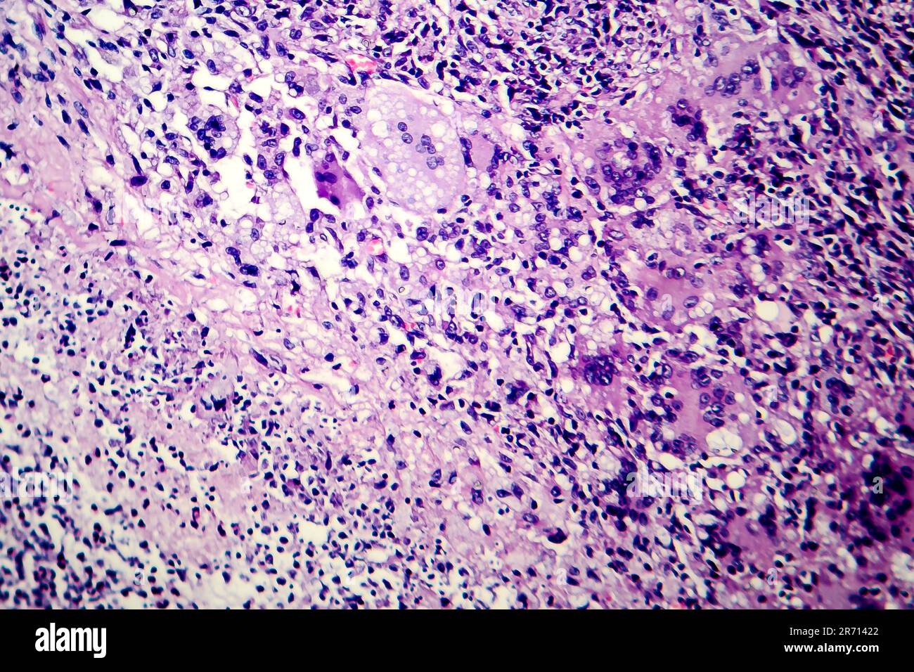 Histopathology of tuberculosis, light micrograph of tuberculosis lesion ...