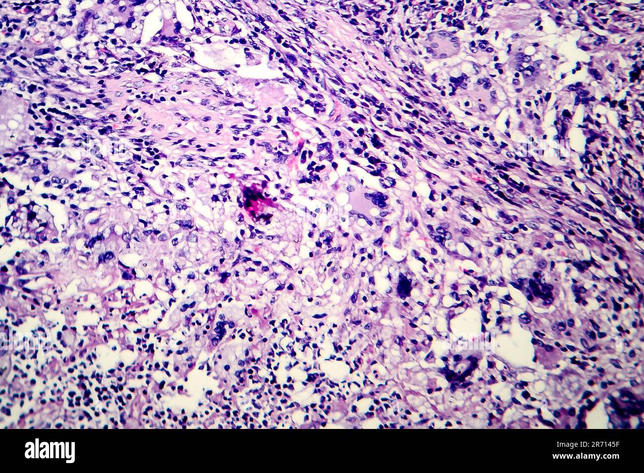 Tuberculosis tissue under microscope hi-res stock photography and ...