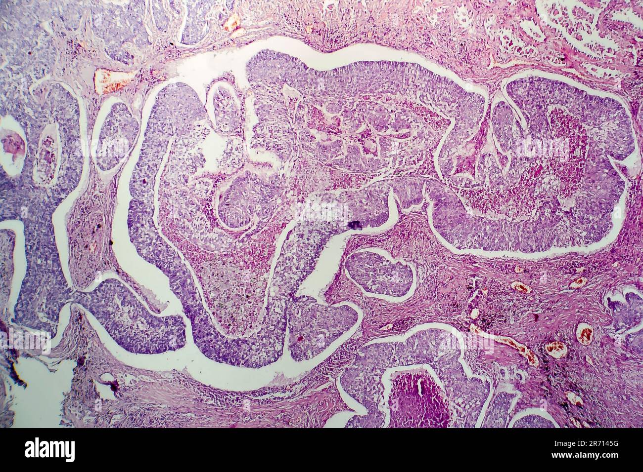 Lung adenocarcinoma, light micrograph, photo under microscope Stock ...
