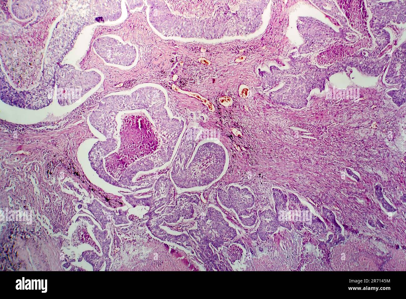 Lung adenocarcinoma, light micrograph, photo under microscope Stock ...