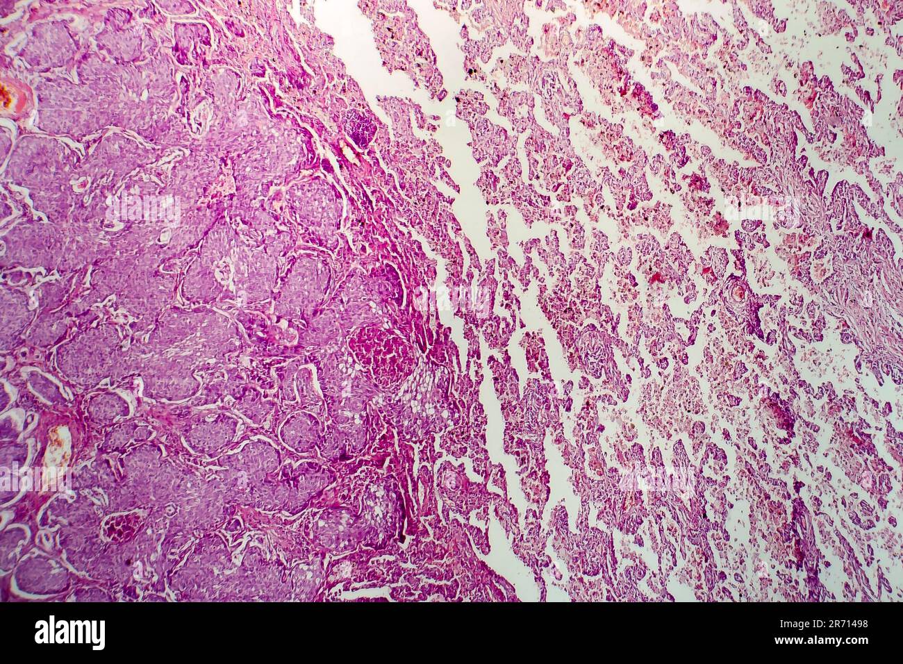 Lung adenocarcinoma, light micrograph, photo under microscope Stock ...