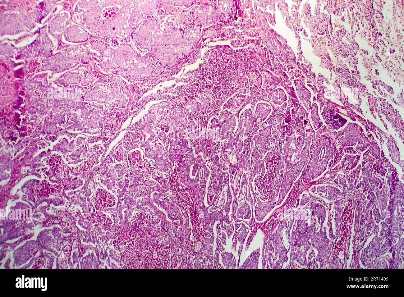 Lung adenocarcinoma, light micrograph, photo under microscope Stock ...