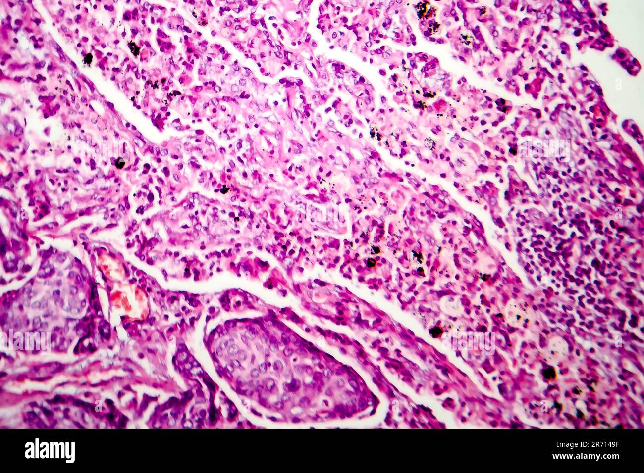 Lung adenocarcinoma, light micrograph, photo under microscope Stock ...