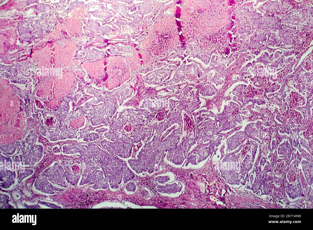 Lung tumour cell hi-res stock photography and images - Alamy