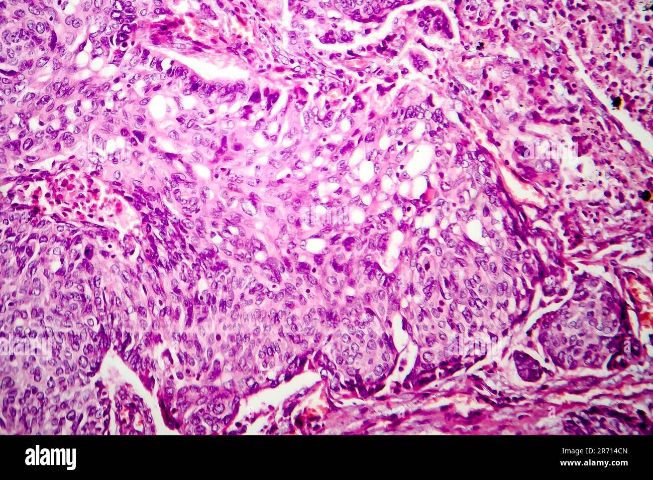 Lung adenocarcinoma, light micrograph, photo under microscope Stock ...