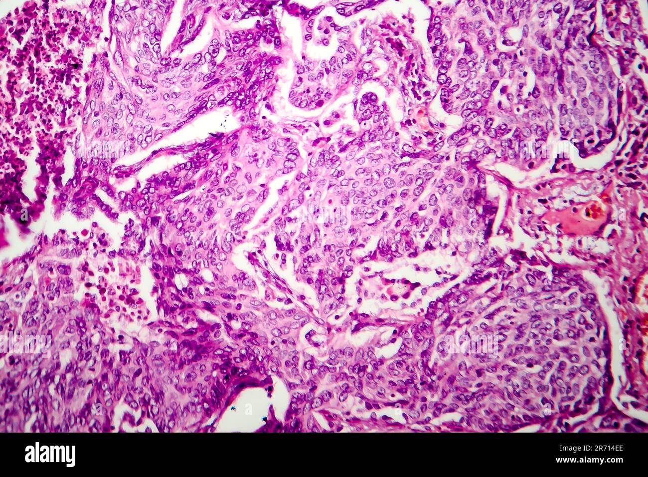 Lung adenocarcinoma, light micrograph, photo under microscope Stock ...