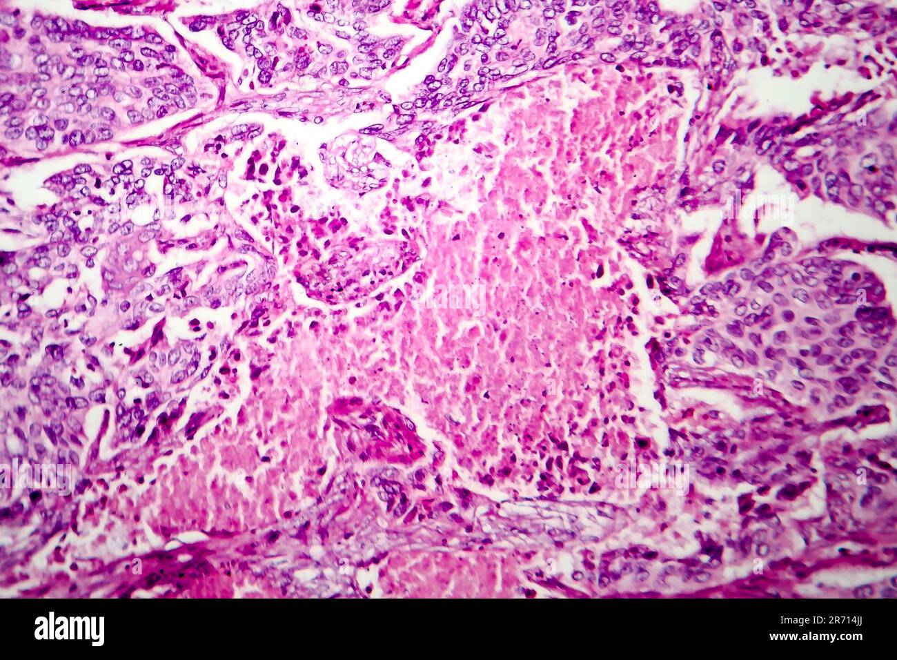 Lung adenocarcinoma, light micrograph, photo under microscope Stock ...