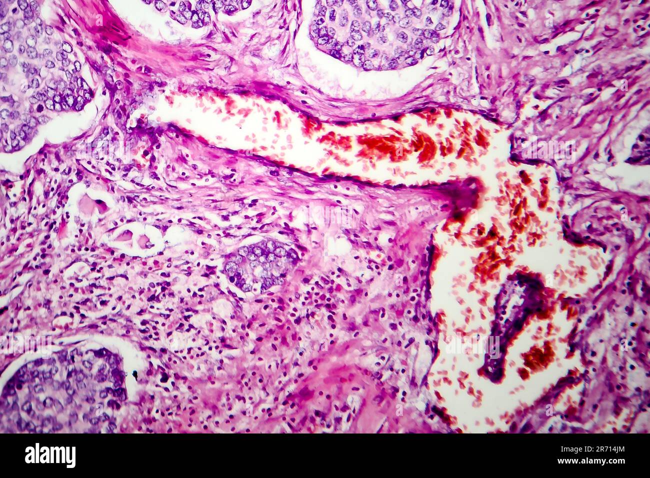 Lung adenocarcinoma, light micrograph, photo under microscope Stock ...