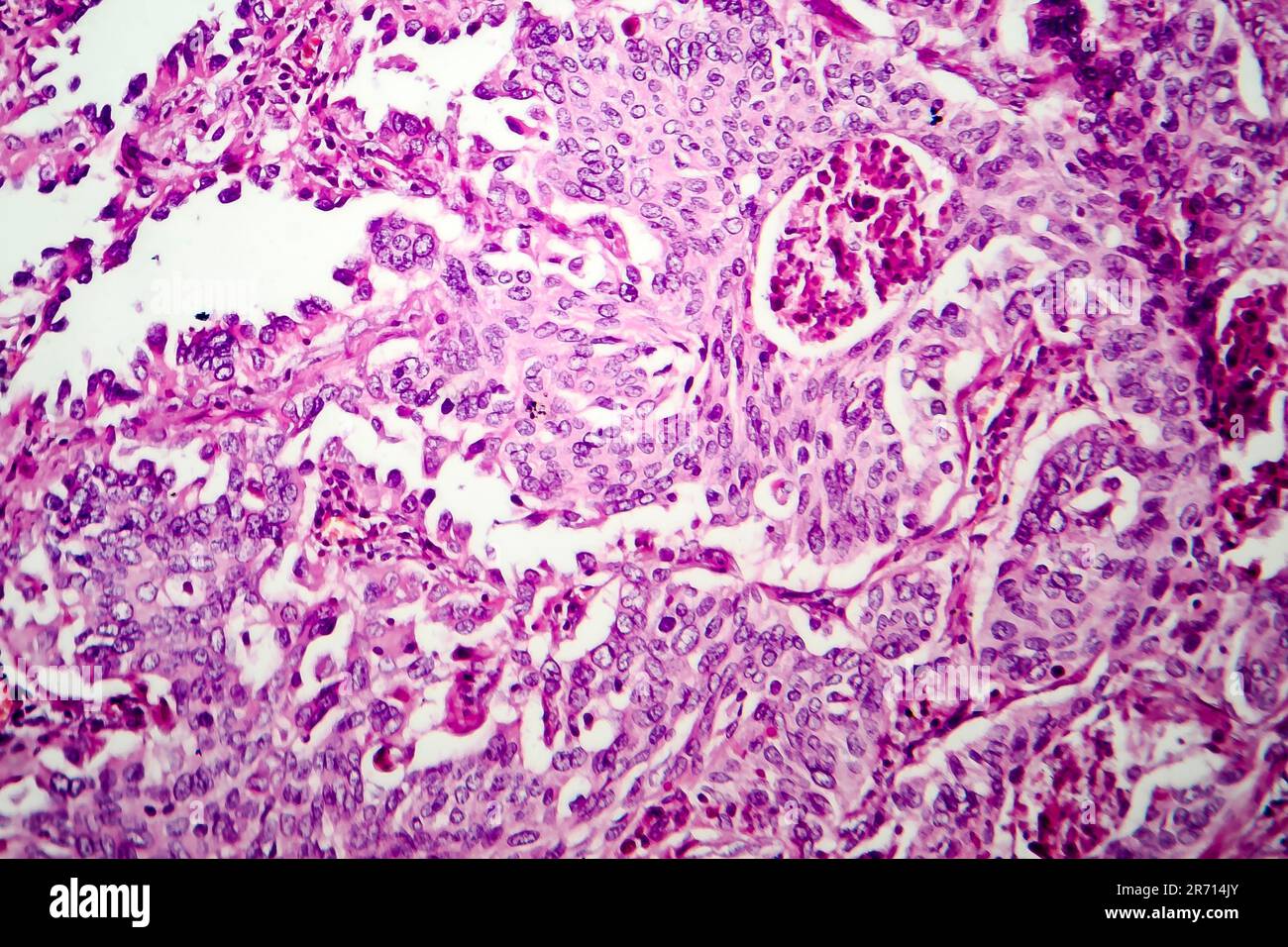 Lung adenocarcinoma, light micrograph, photo under microscope Stock ...