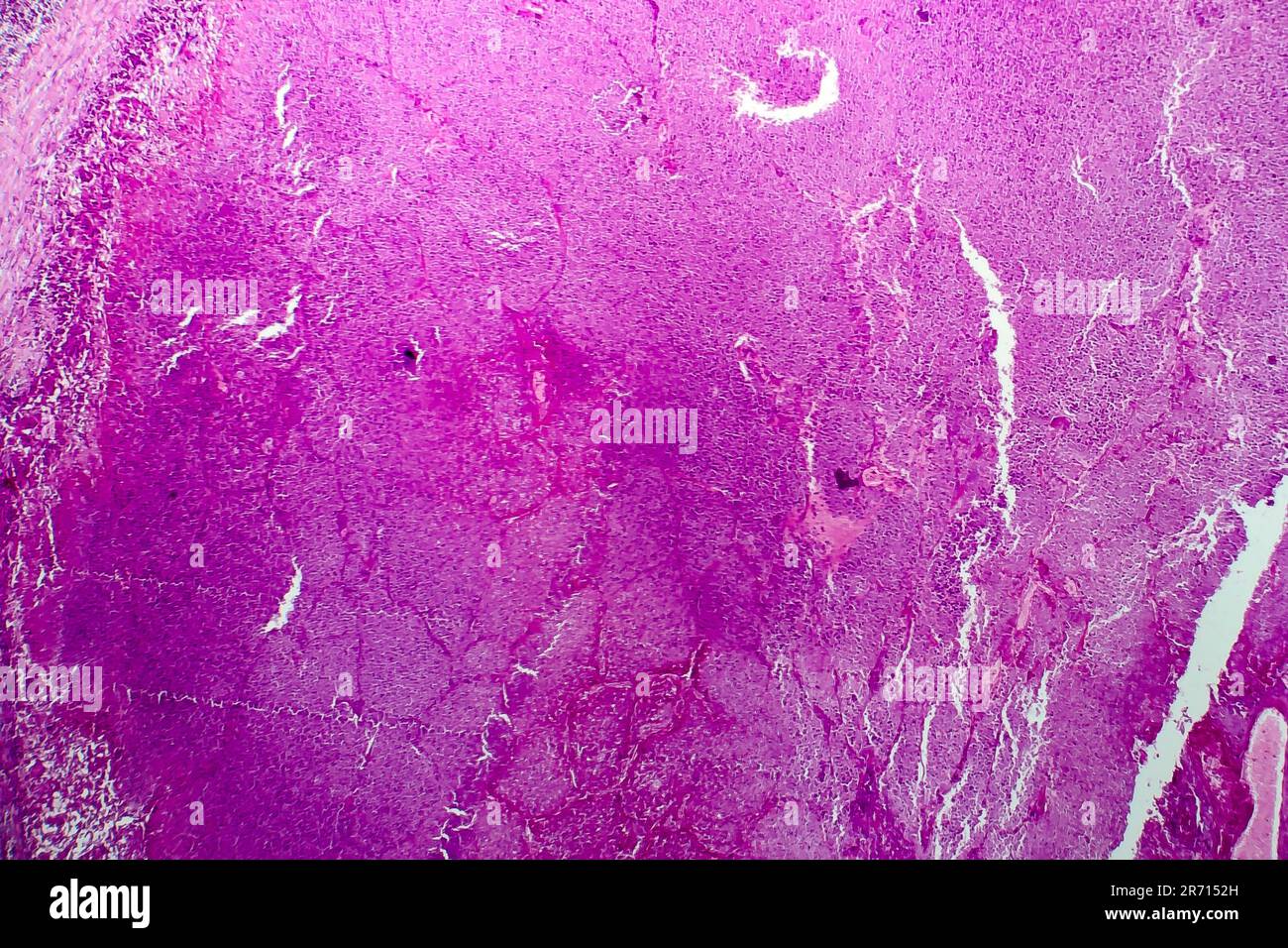 Caseation of human tuberculosis granuloma, light micrograph, photo ...