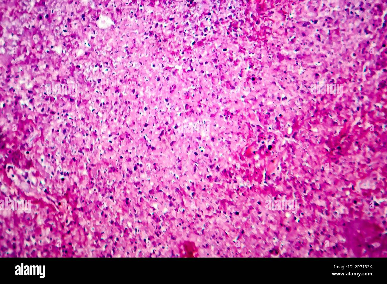 Caseation of human tuberculosis granuloma, light micrograph, photo ...