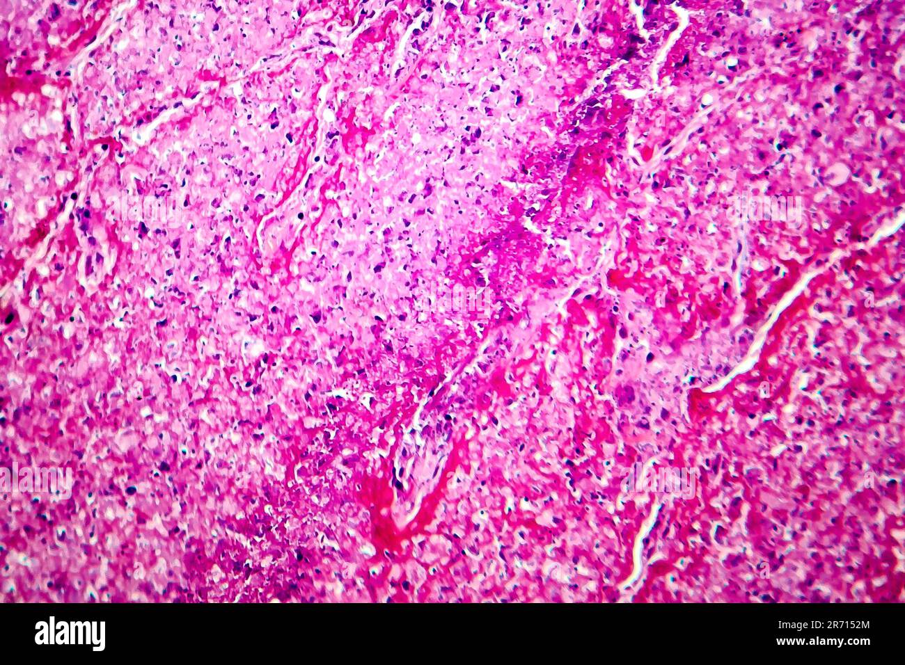 Caseation of human tuberculosis granuloma, light micrograph, photo ...