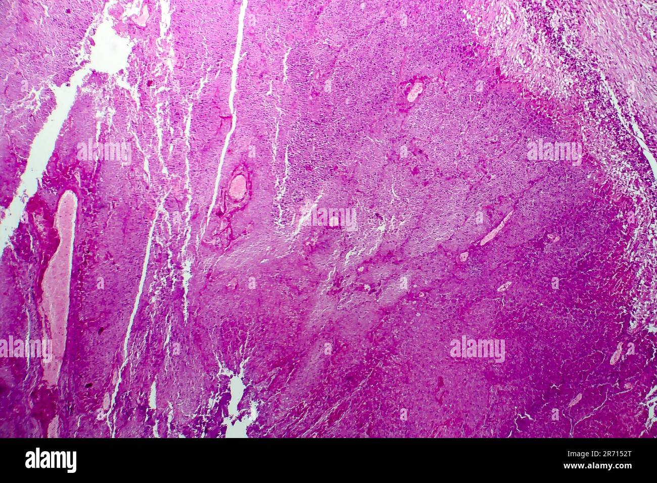Caseation of human tuberculosis granuloma, light micrograph, photo ...